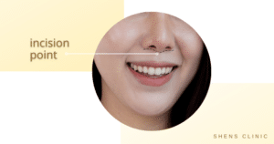 Philtrum Reduction and Contouring - Upper Lip Lift | Shens Clinic